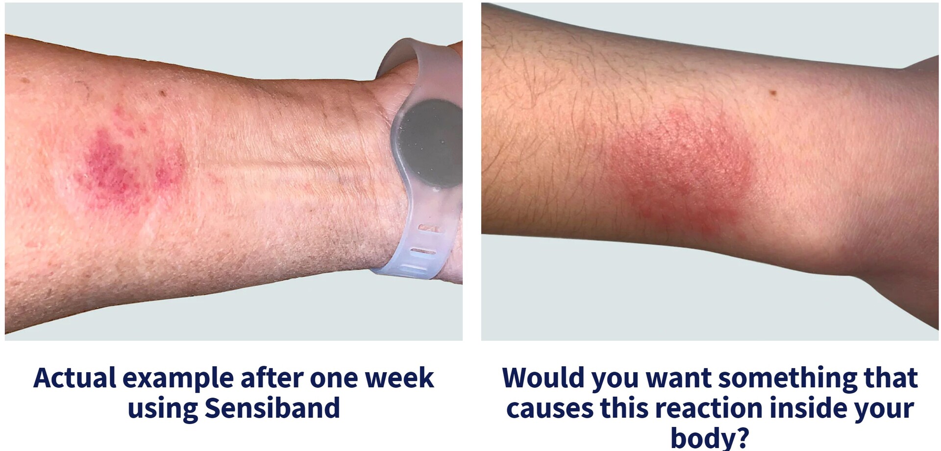 Sensiband launches Metal Allergy Test wearable to reduce risk of ...